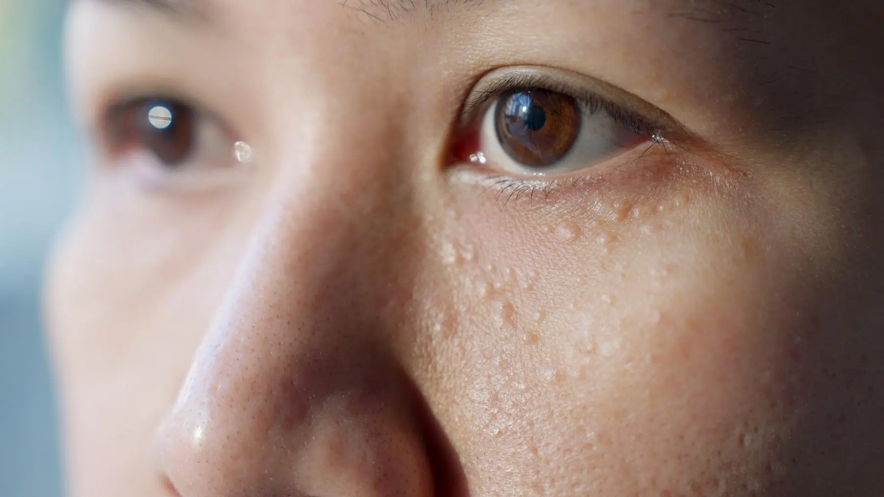 Milia Around The Eyes - Causes & Treatment | Gardenia Skin Co